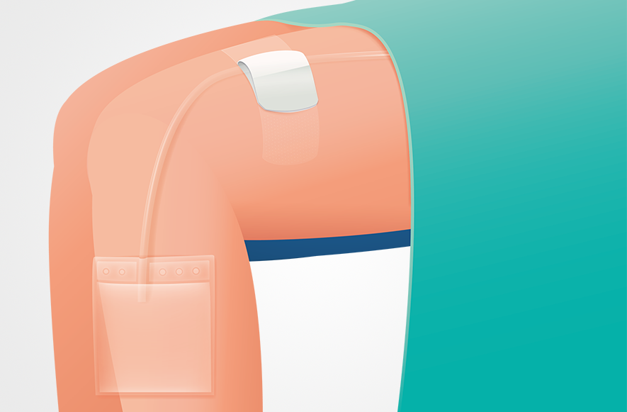 Fixiersysteme - Spezialisierte Fixierlösungen für medizinische Zu- und ...