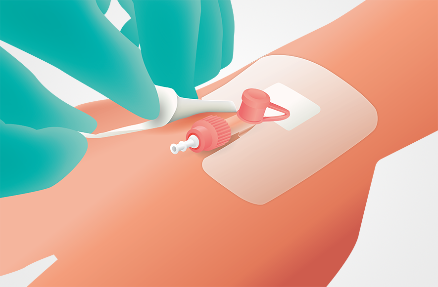 Fixation systems - Specialised fixation solutions for medical entrances ...
